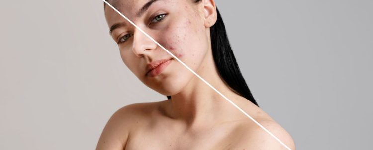 ACNÉ - Clínica Jaime I Catarroja en Valencia