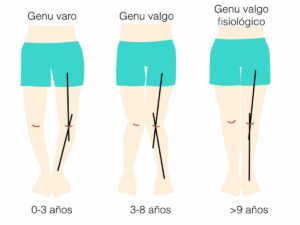 Genu Valgo: Causas, síntomas y tratamiento de esta deformidad de las ...