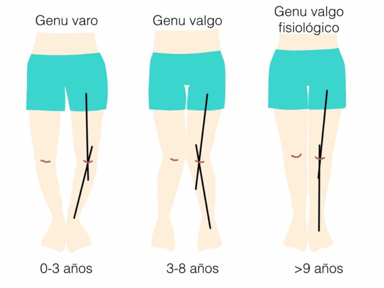 Genu Valgo: Causas, síntomas y tratamiento de esta deformidad de las ...
