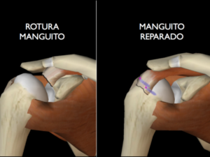 Rotura del manguito rotador: causas, síntomas y tratamiento | Traumatología