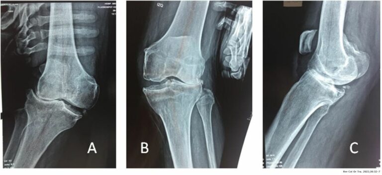 Genu Valgo: Causas, síntomas y tratamiento de esta deformidad de las ...
