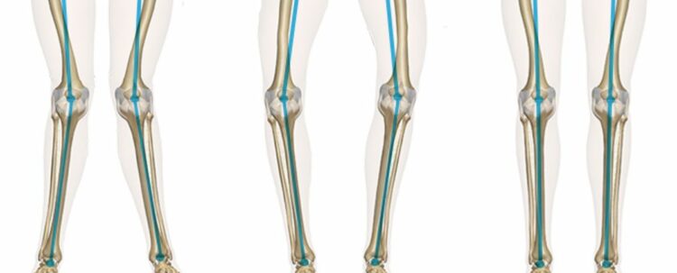 Genu Valgo: Causas, síntomas y tratamiento de esta deformidad de las ...