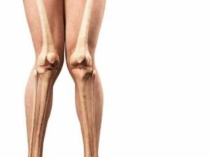 Genu Valgo: Causas, síntomas y tratamiento de esta deformidad de las ...