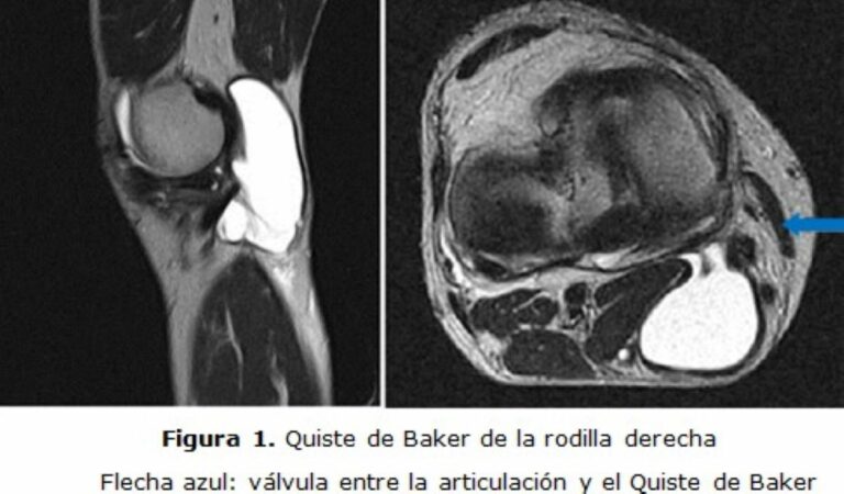 Quiste de Baker: Síntomas, causas y tratamientos en la rodilla - Blog ...