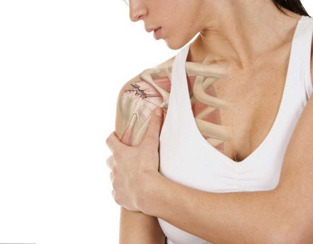Incapacidad Por Síndrome Subacromial Y Tendinitis De Hombro – LWMDUH