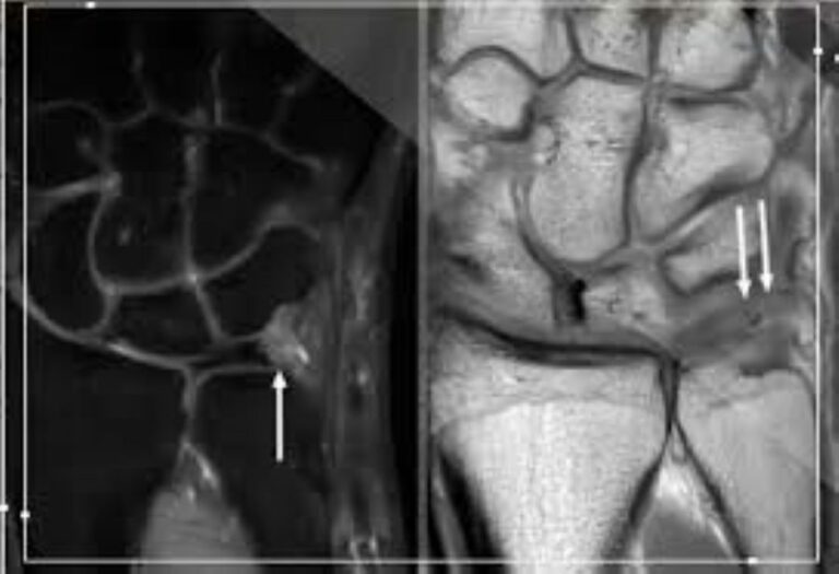 Rotura Del Fibrocartílago Triangular Síntomas Tratamiento Y