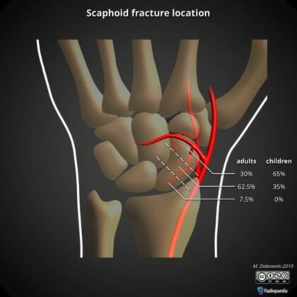 Fractura de escafoides: Síntomas, diagnóstico y tratamiento