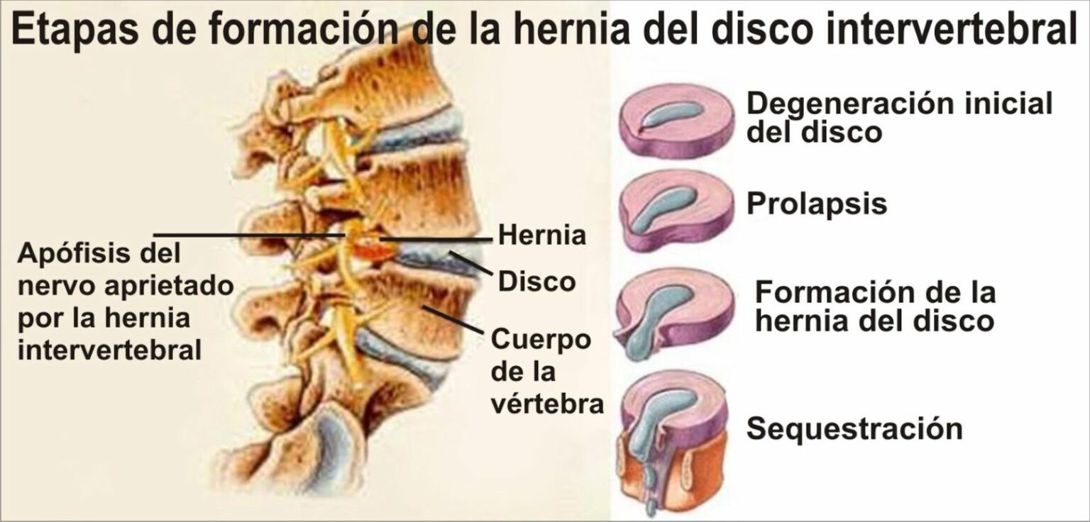 Degeneración de los discos intervertebrales: causas y tratamientos para ...