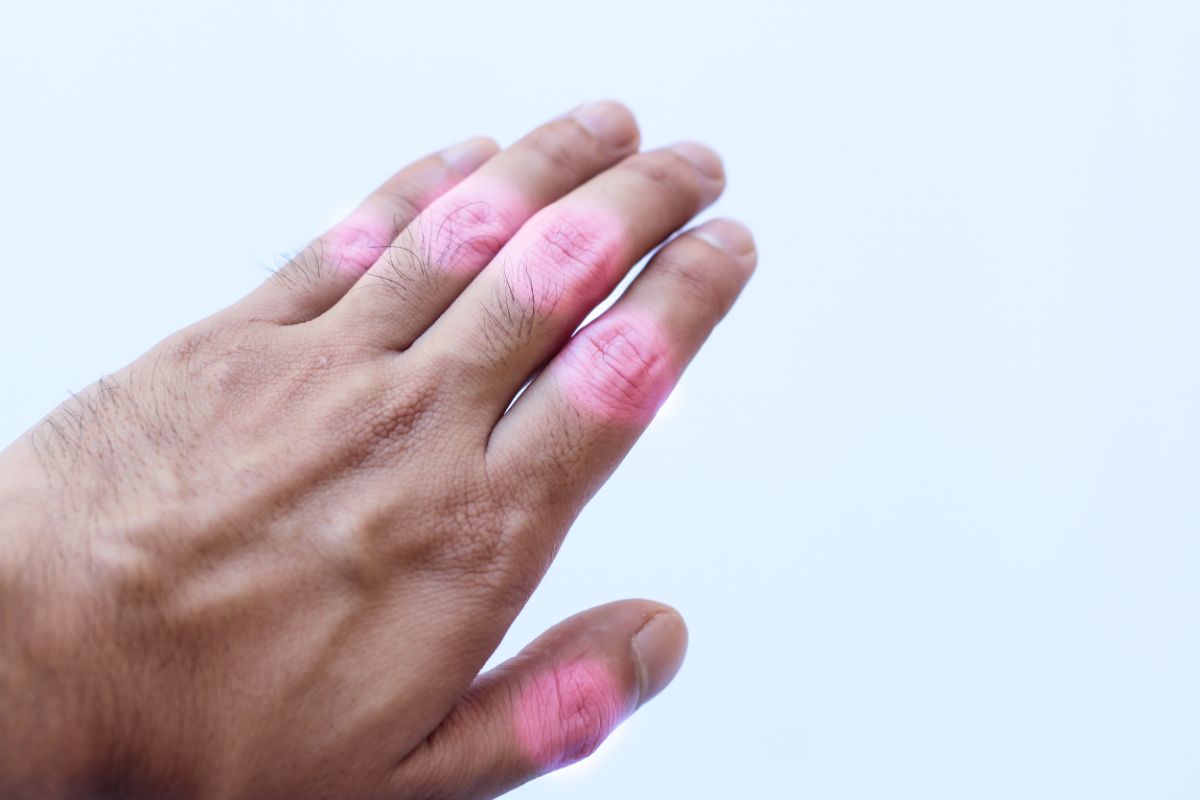 Artritis reumatoide: síntomas, diagnóstico y tratamientos en ...