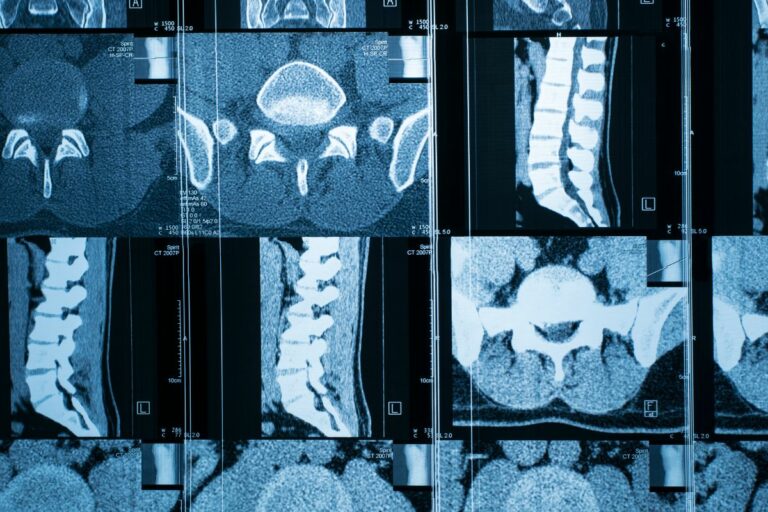 La ciática: causas, síntomas y tratamientos efectivos
