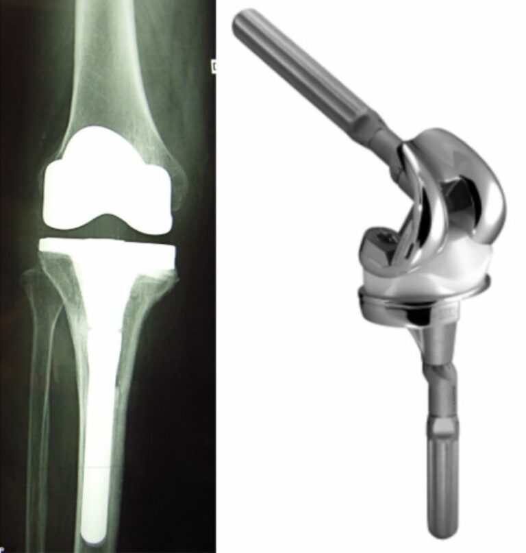 Prótesis de rodilla: Una solución para recuperar tu movilidad ...