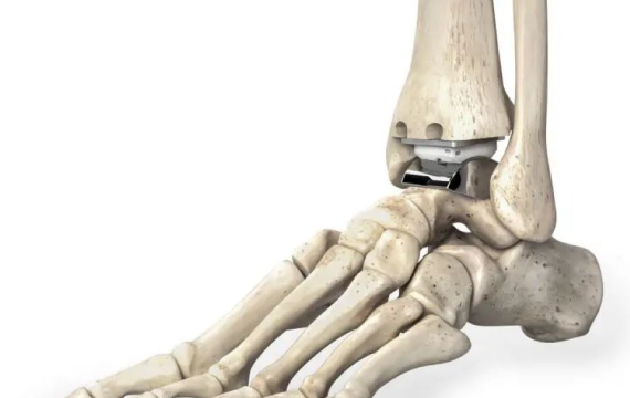 Prótesis de Tobillo en Valencia | Clínica Jaime I Catarroja - Valencia