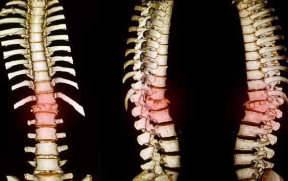 Deformidades | Traumatismos de la Columna Vertebral en Valencia ...