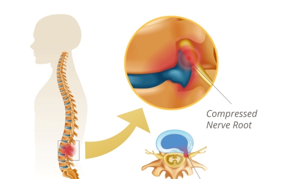 Lesión medular en Valencia | Clínica Jaime I Catarroja - Valencia