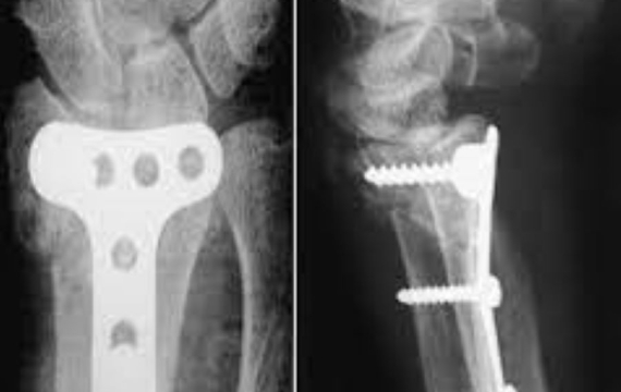 Osteosíntesis en Valencia | Clínica Jaime I Catarroja - Valencia